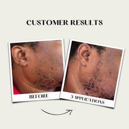 17BLEND Hair Growth Follicle Stimulator Oil | Issa Miracle